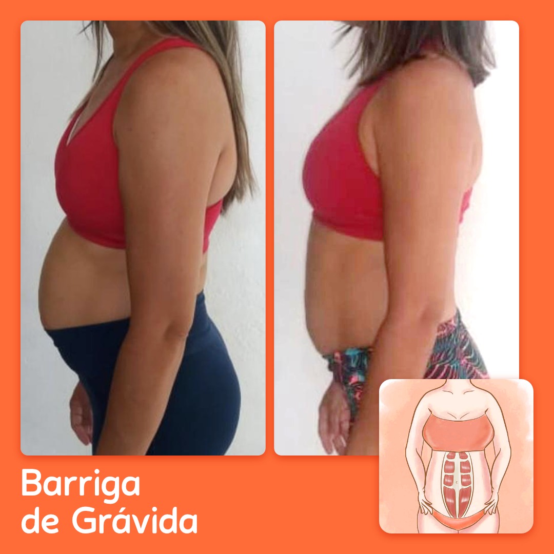 barriga de grávida - Gizele Monteiro - Mães sem Diástase