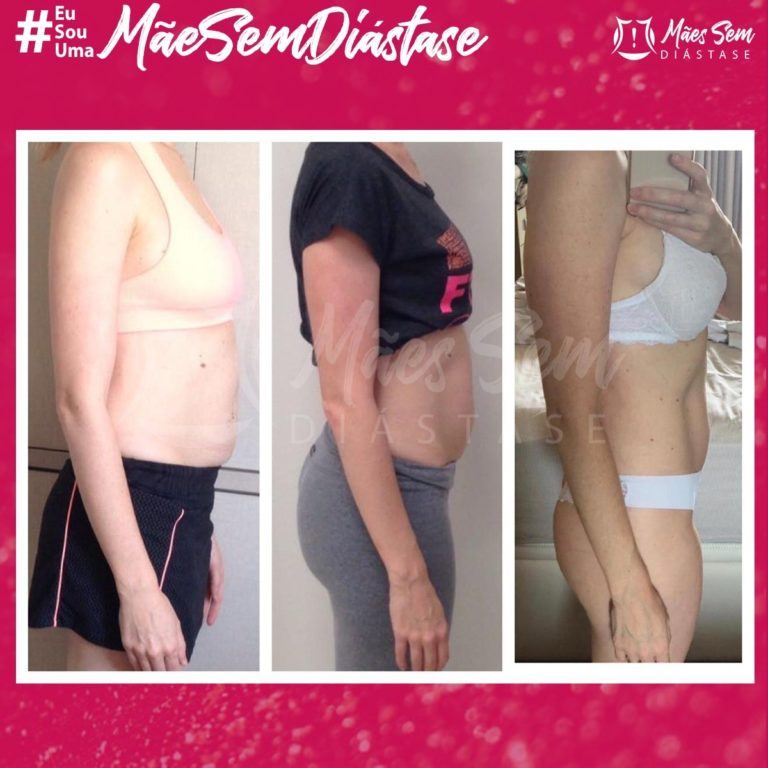 Como fechar a Diástase abdominal em casa - Gizele Monteiro - Mães sem Diástase